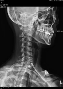 When Neck Problems Cause Finger Tingling: What Patients Often Miss ...